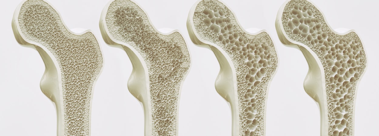 Whole genome sequencing identifies new genetic determinants of Familial ...